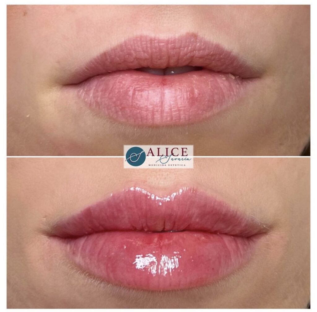 Filler labbra Rimini - Filler labbra con tecnica standard, vertical ...