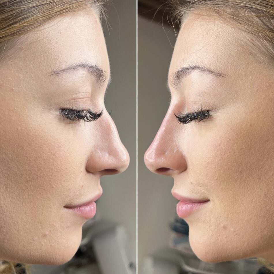 Rinofiller Milano - Rimodellamento del naso senza chirurgia